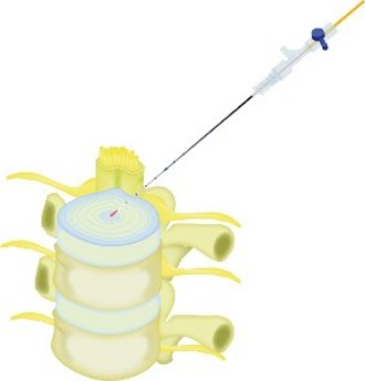 Press Info_16.06.2021 / Biolitec